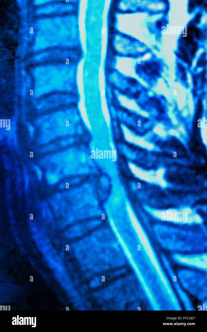 Herniated disc mri hi-res stock photography and images - Alamy
