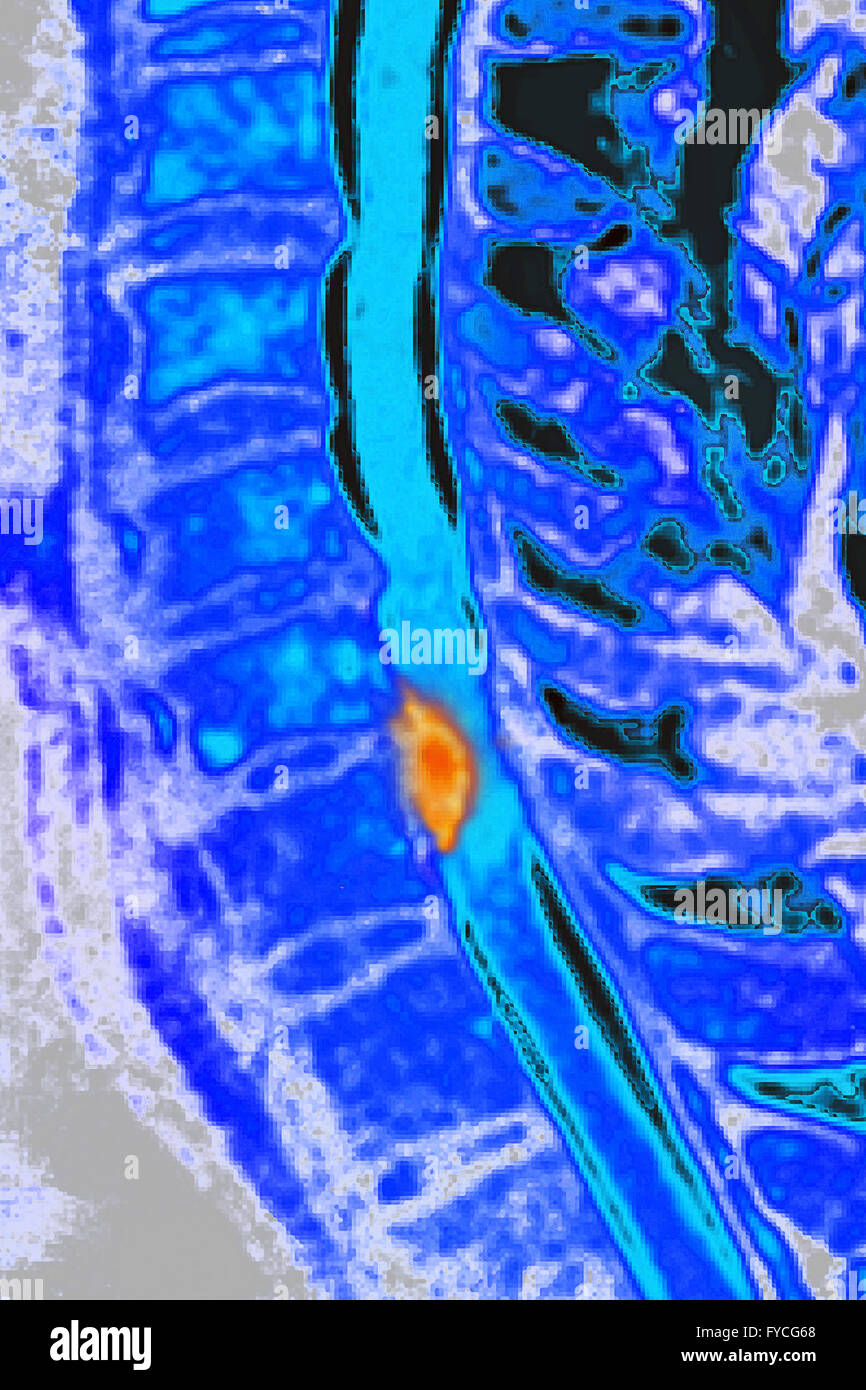 Herniated disc mri hi-res stock photography and images - Alamy