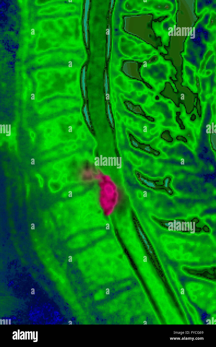 Mri of herniated disc hi-res stock photography and images - Alamy