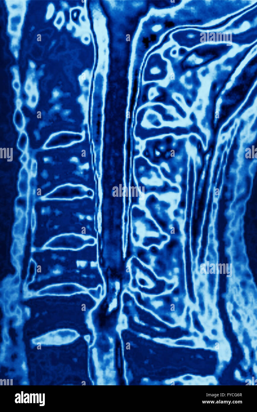 Mri of herniated disc hi-res stock photography and images - Alamy