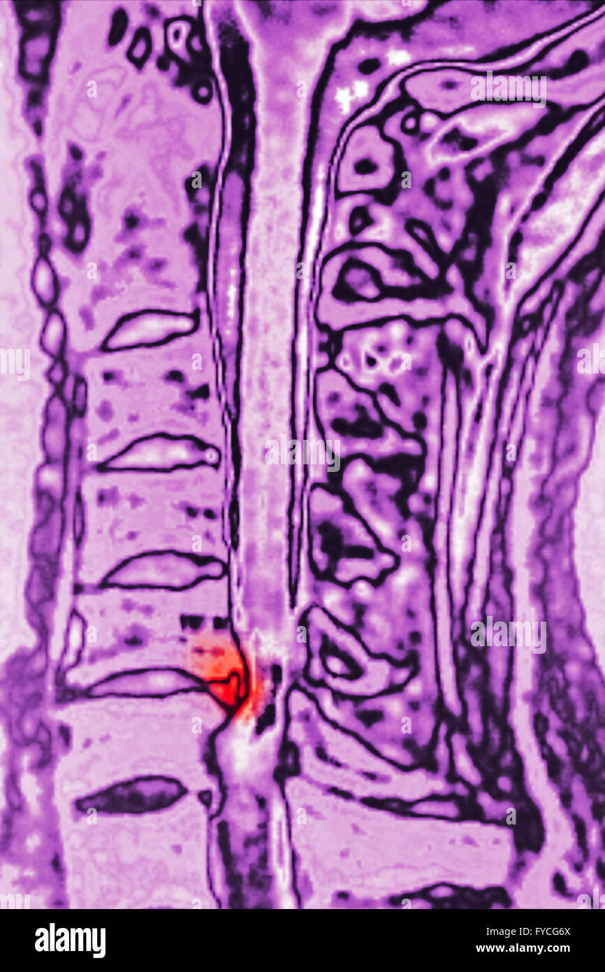 Mri of herniated disc hi-res stock photography and images - Alamy