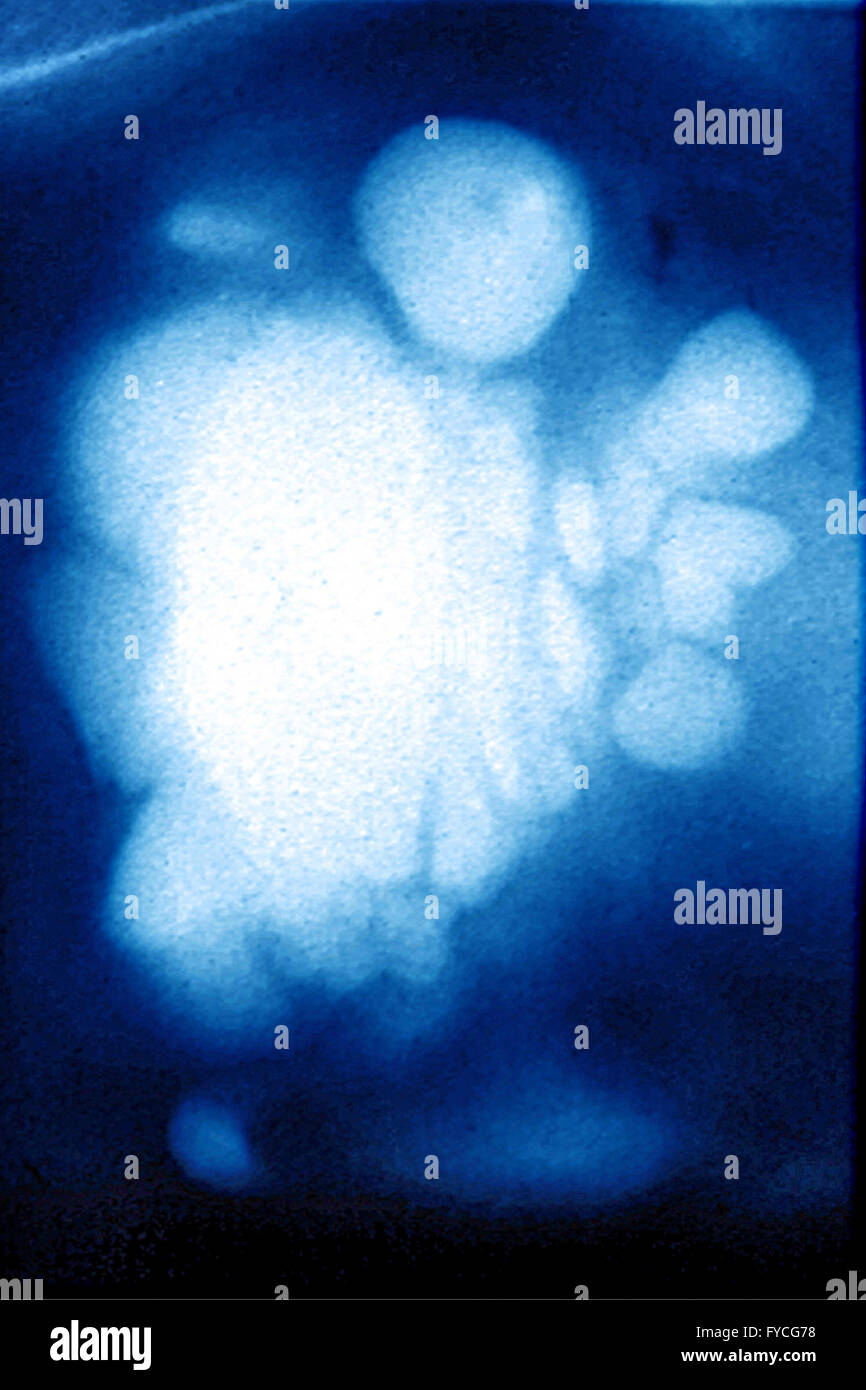 Renal cysts hi-res stock photography and images - Alamy