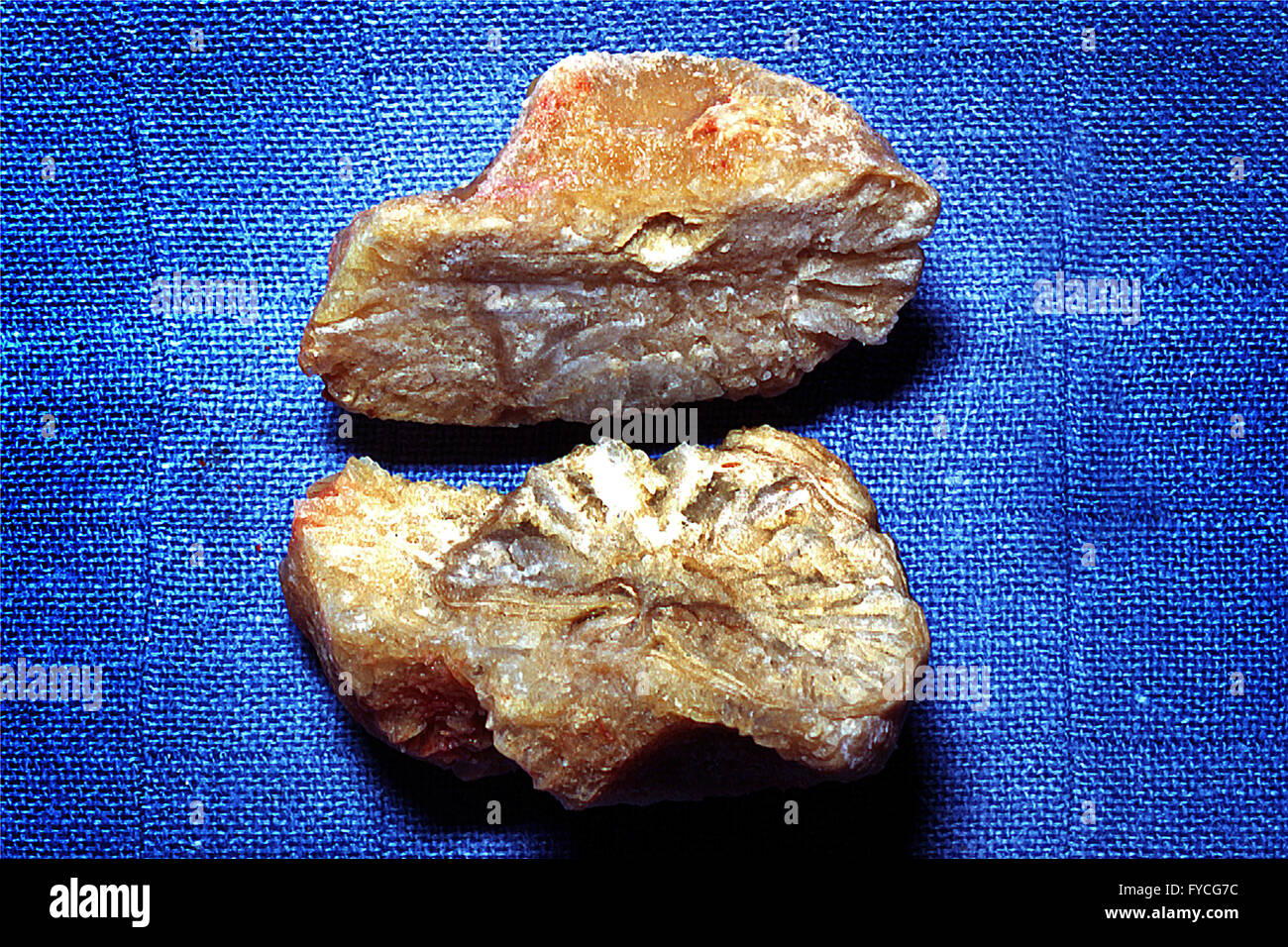 Kidney stones hi-res stock photography and images - Alamy