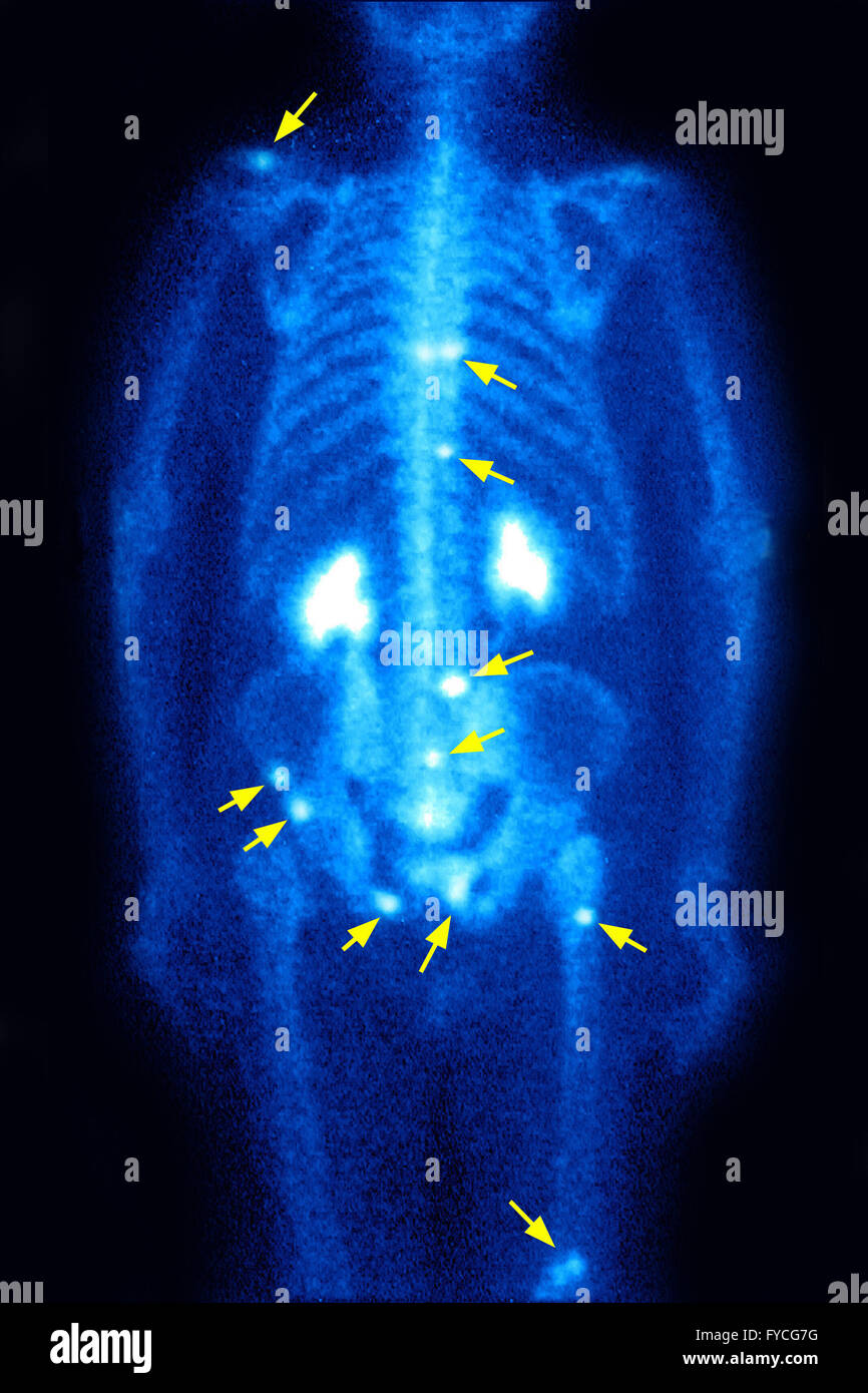 Gamma scan of bone cancer hi-res stock photography and images - Alamy