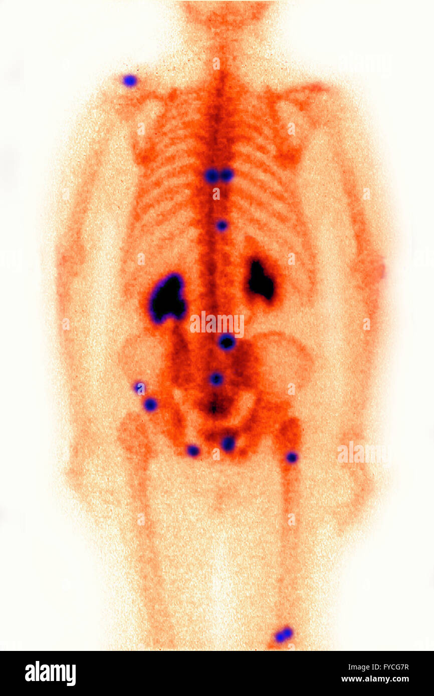 Gamma scan of bone cancer hi-res stock photography and images - Alamy