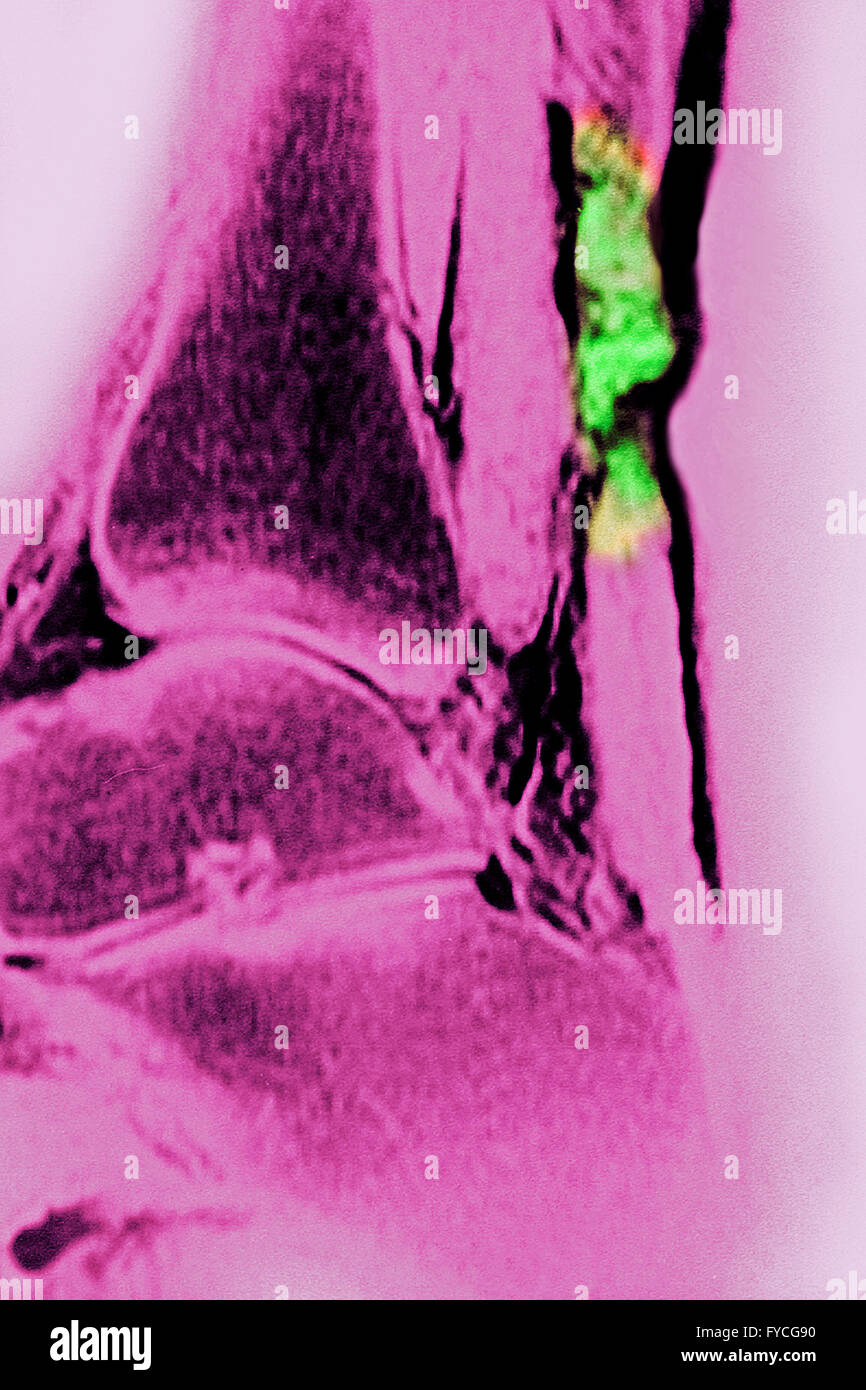 RUPTURED TENDON, MRI Stock Photo - Alamy