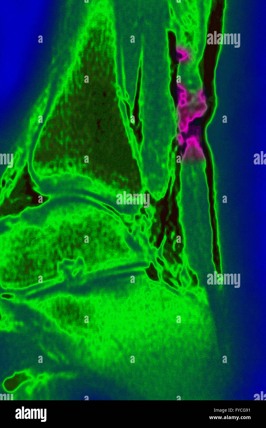 Ruptured tendon hi-res stock photography and images - Alamy