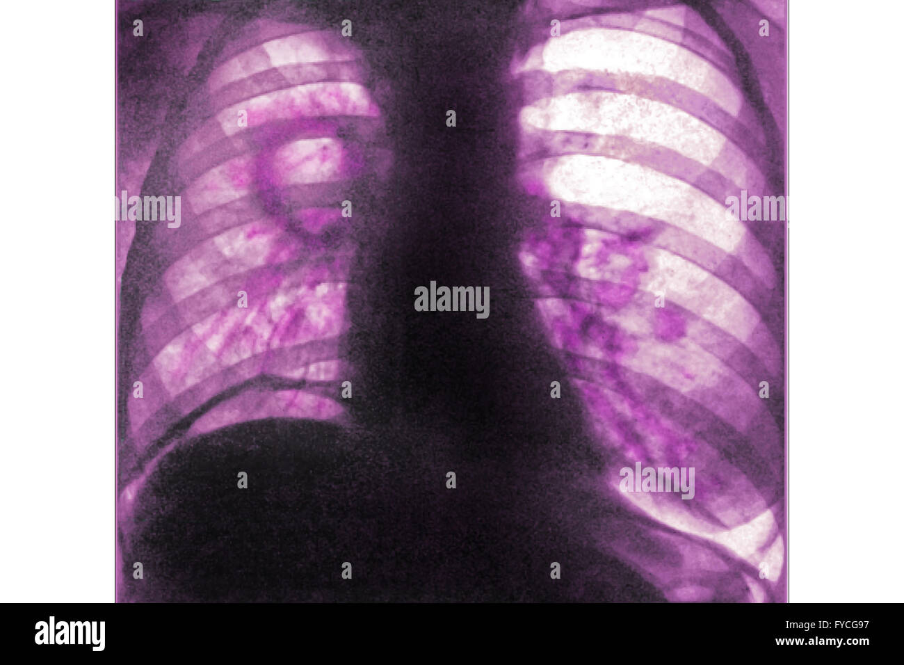 PULMONARY TUBERCULOSIS, X-RAY Stock Photo - Alamy