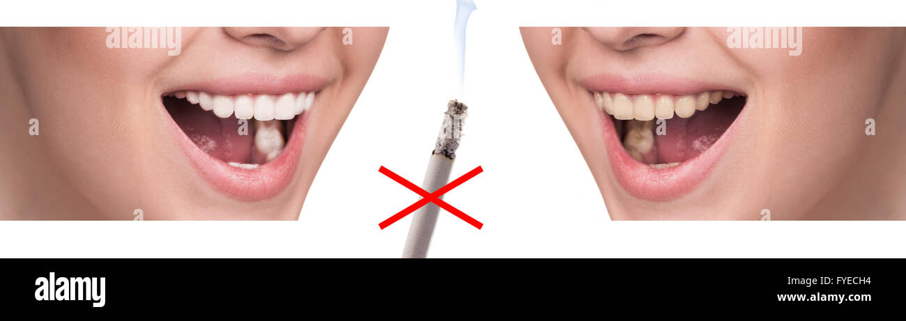 Smile before and after smoking Stock Photo - Alamy