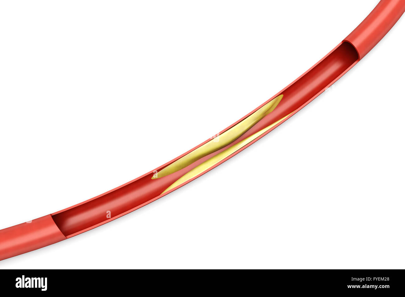 Arteriosclerosis therapy hi-res stock photography and images - Alamy