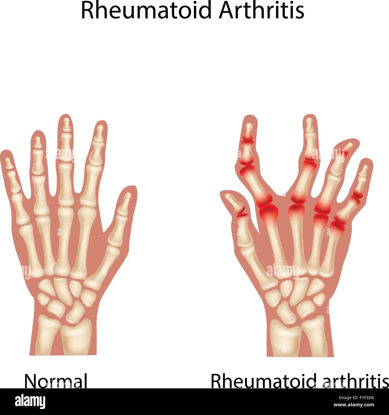 Illustration of Rheumatoid Arthi Stock Vector Image & Art - Alamy