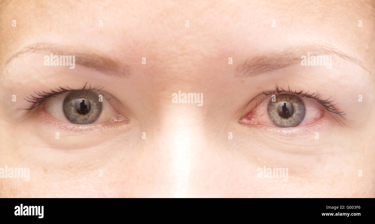 Stressed eye hi-res stock photography and images - Alamy