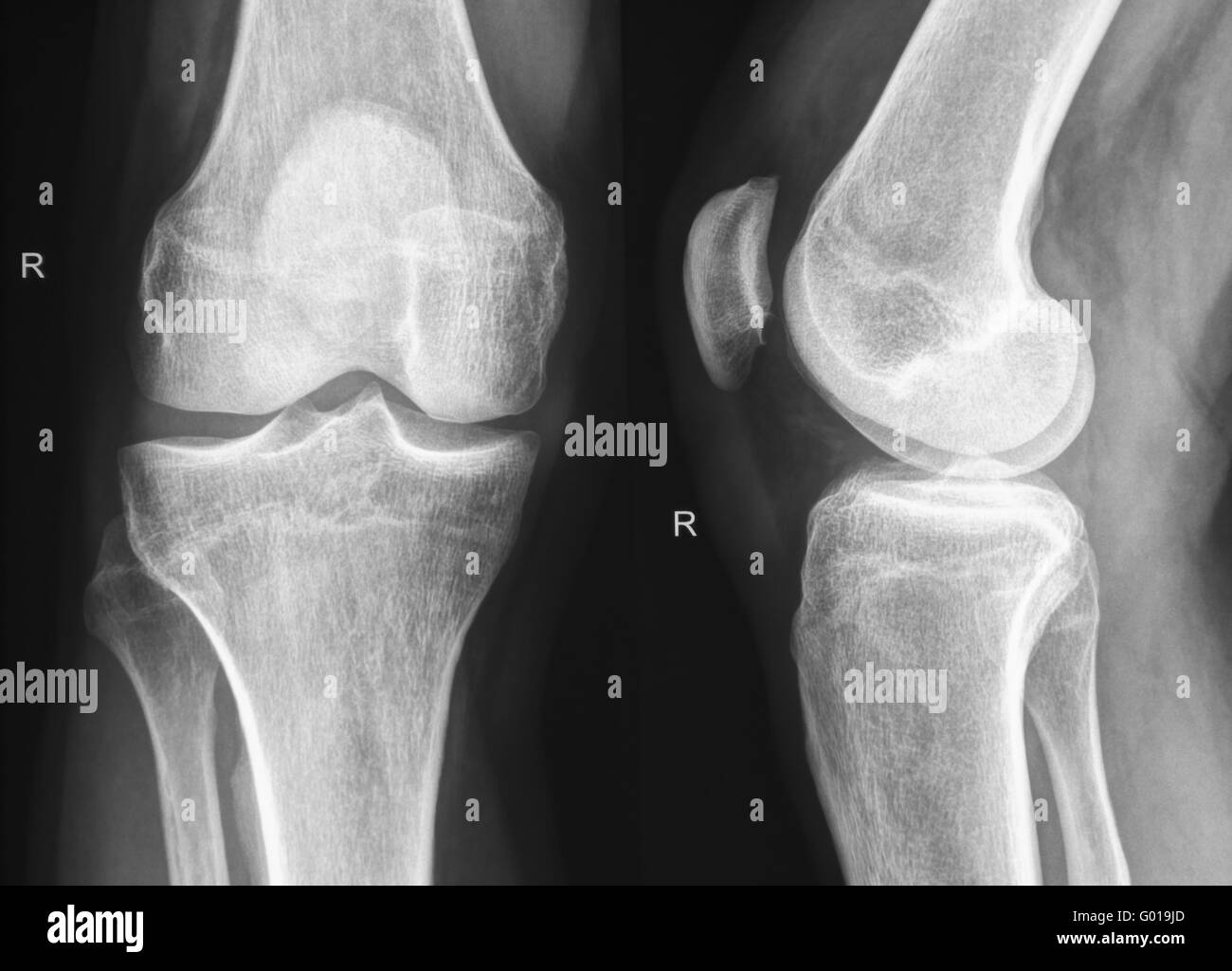 Knee joint Black and White Stock Photos & Images - Alamy
