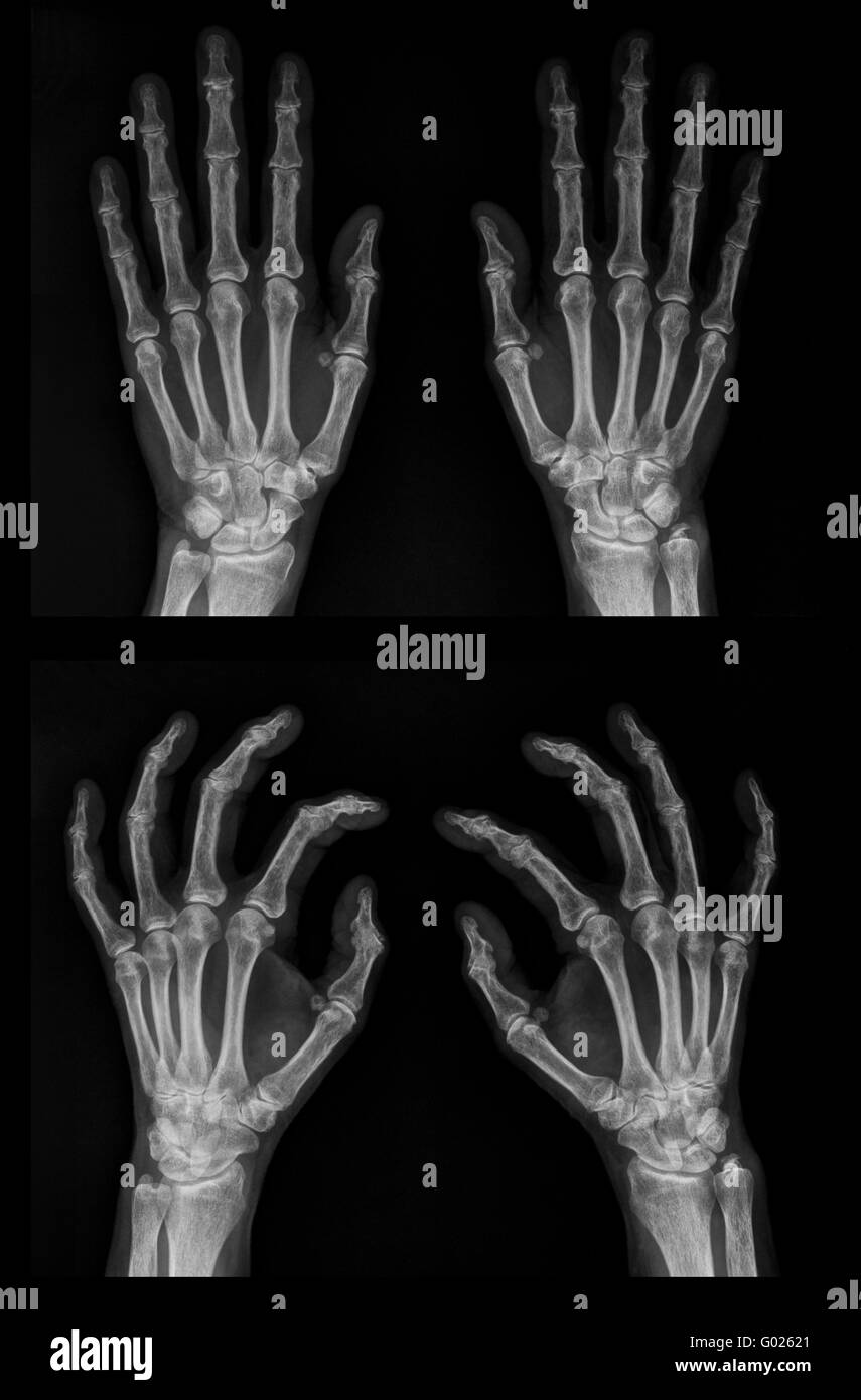 Rontgen Hand High Resolution Stock Photography and Images - Alamy