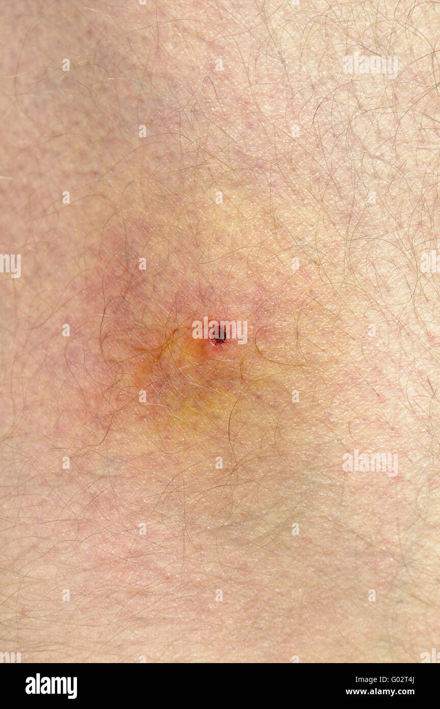 Tick bite hi-res stock photography and images - Alamy
