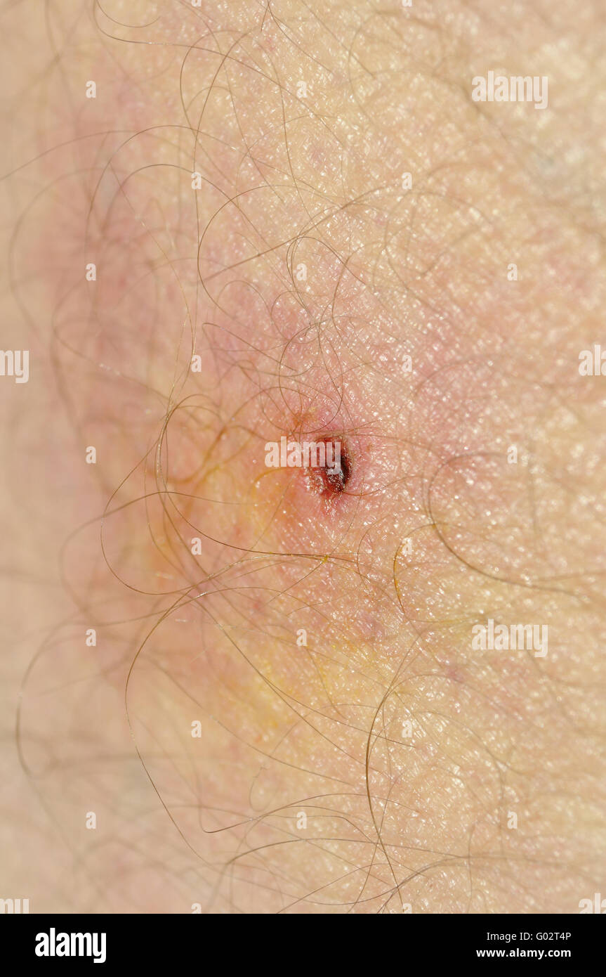 Zeckenbiss hi-res stock photography and images - Alamy