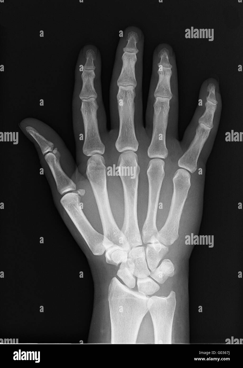 Gout hand hi-res stock photography and images - Alamy