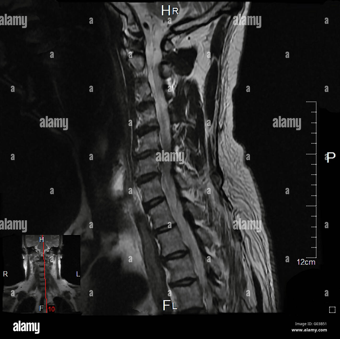 Mri neck hi-res stock photography and images - Alamy