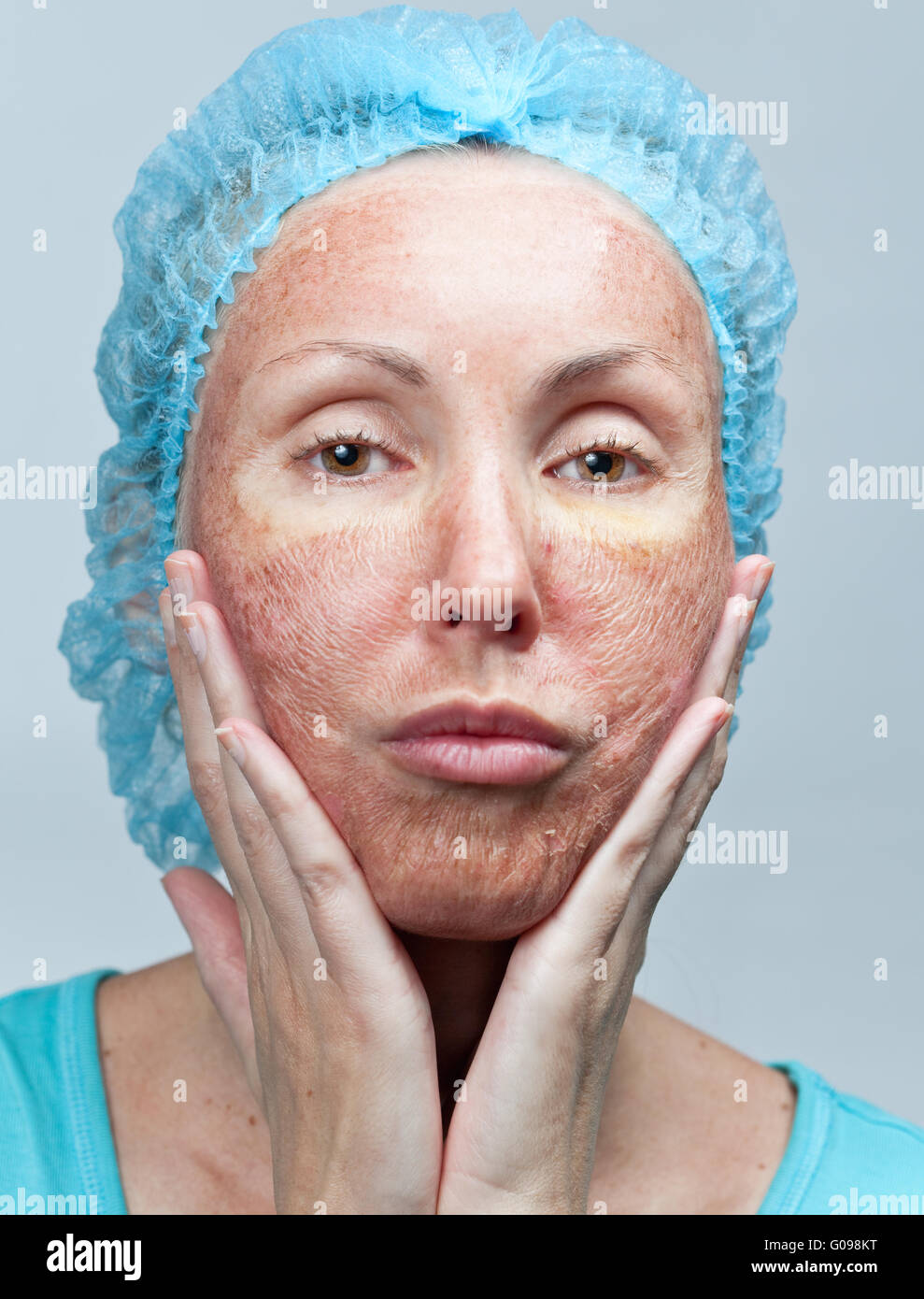 Chemical peeling. Parchment skin before rejecti Stock Photo - Alamy