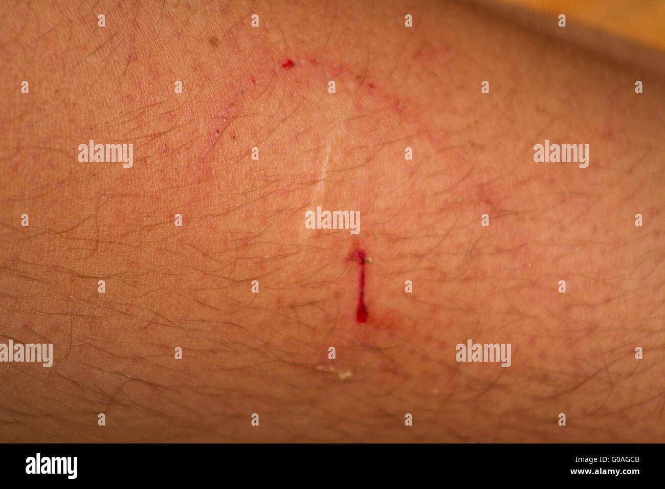 Gash wound hi-res stock photography and images - Alamy