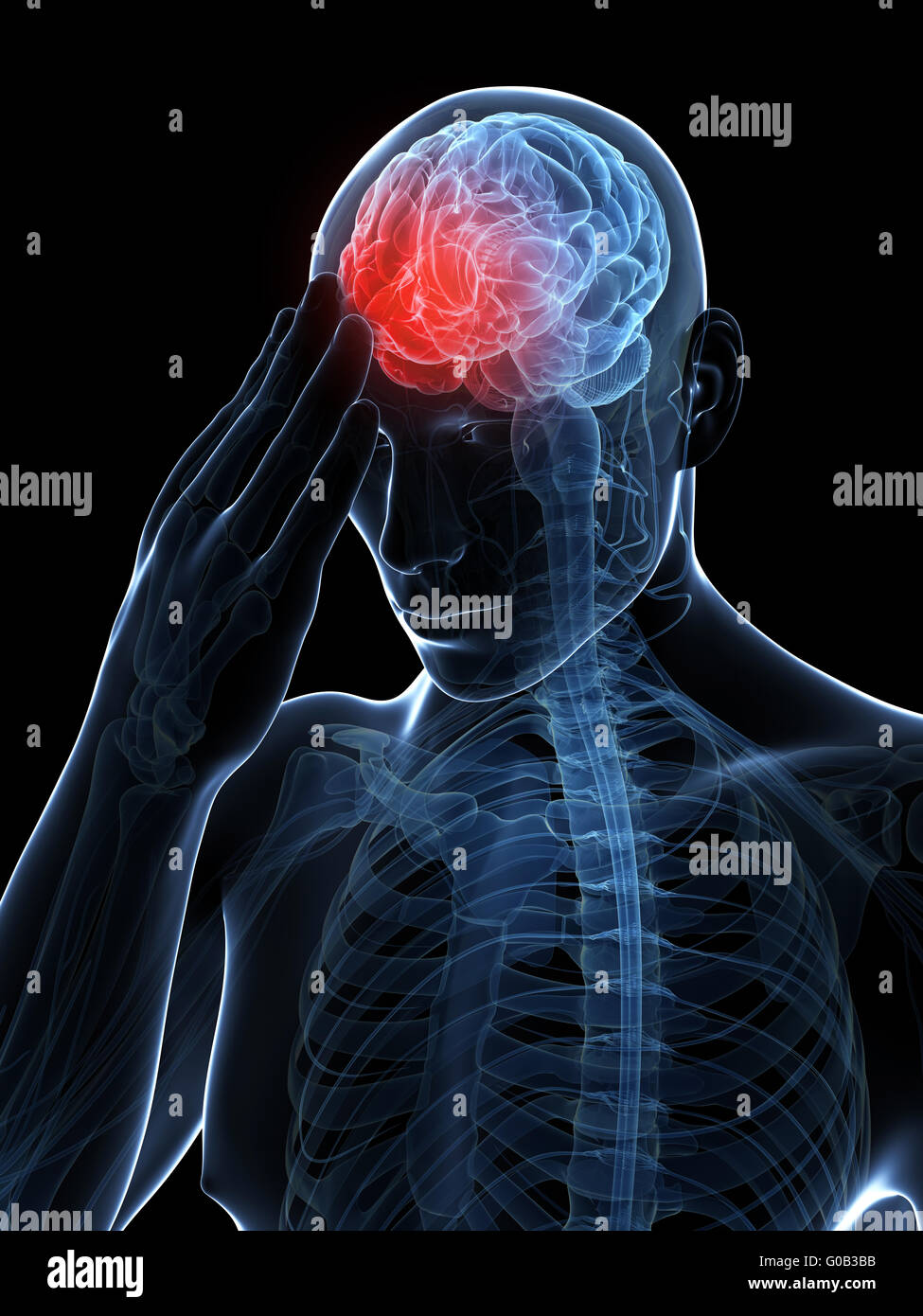 3d rendered conceptual illustration of head pain Stock Photo - Alamy