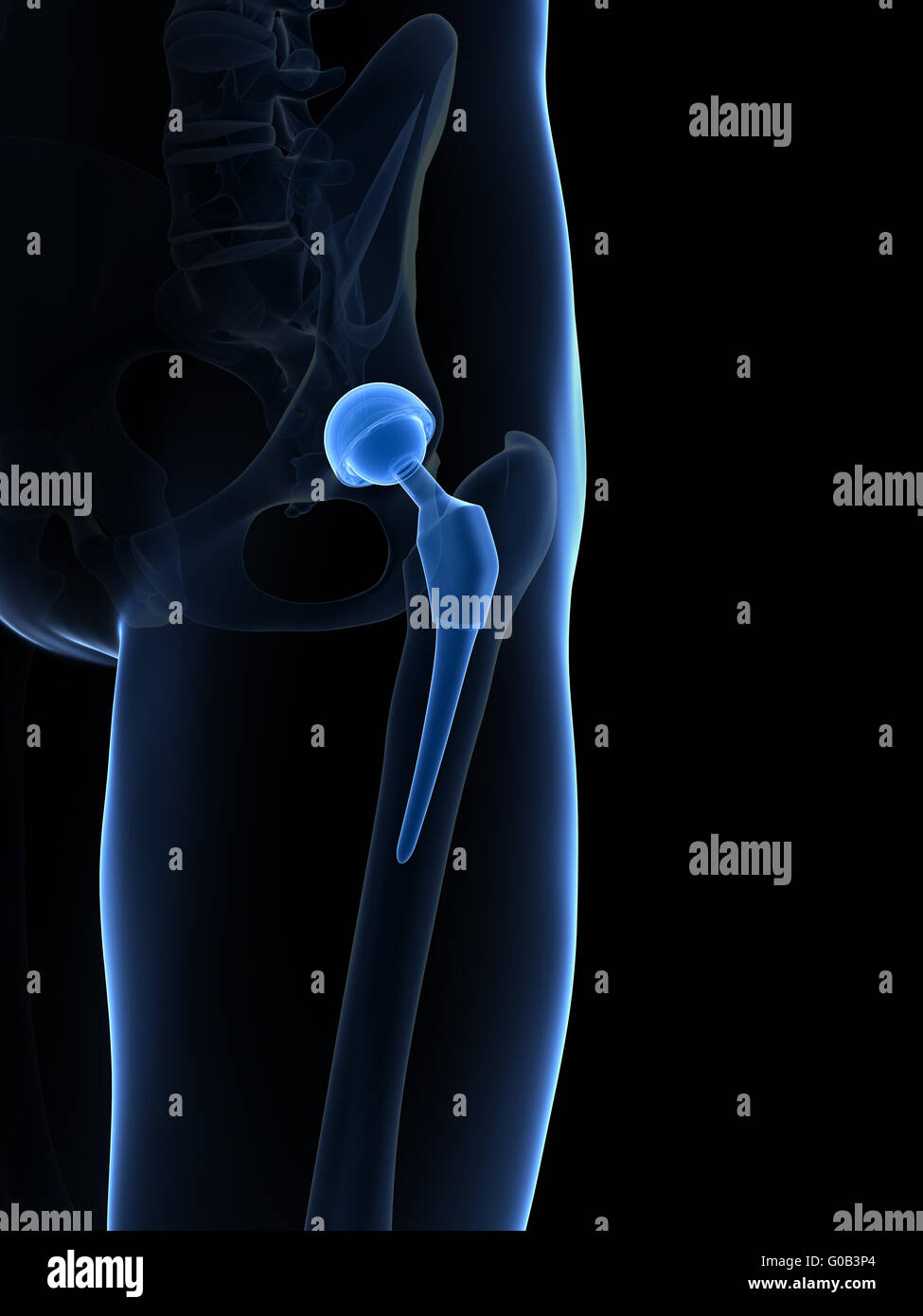 Hip implant medical illustration hi-res stock photography and images ...