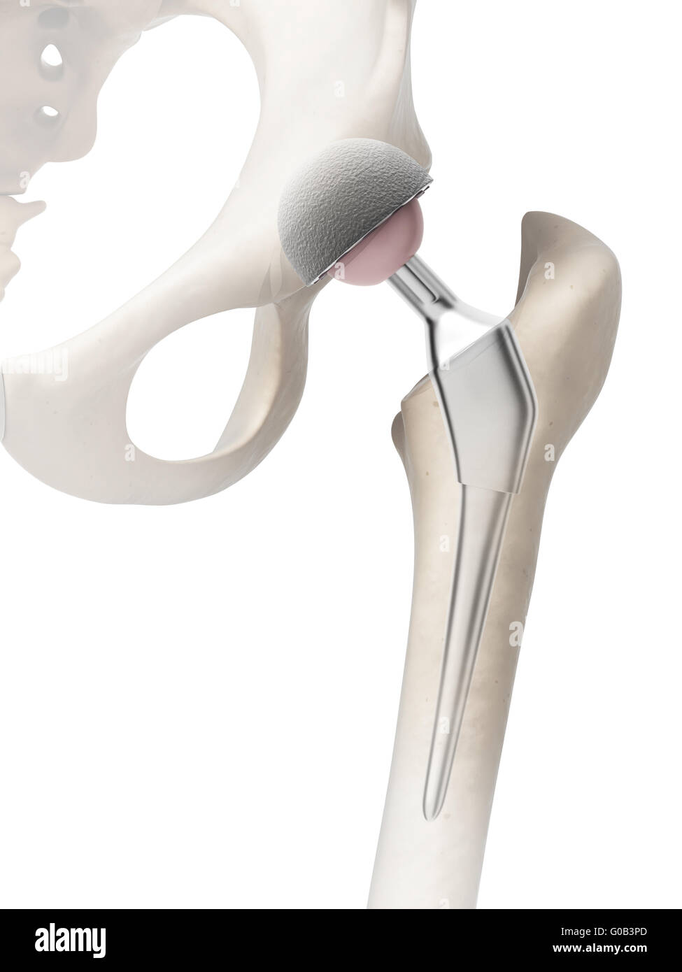 Hip replacement hi-res stock photography and images - Alamy