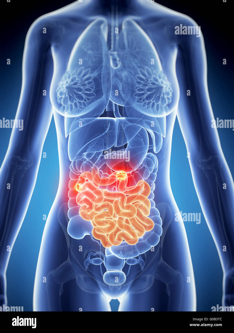 3d rendered illustration of the female anatomy - intestine cancer Stock ...