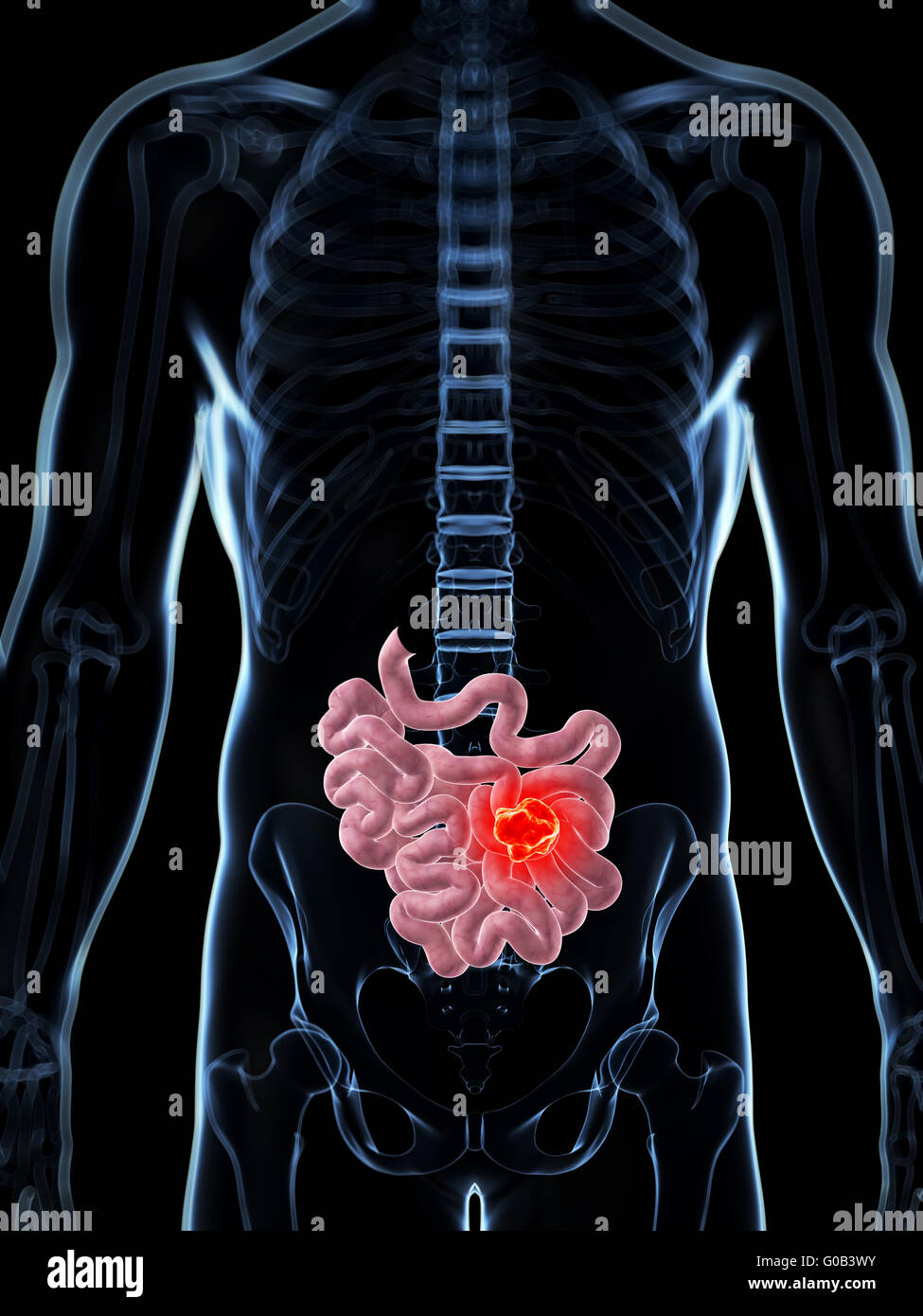 3d rendered illustration of the male small intestine - cancer Stock ...