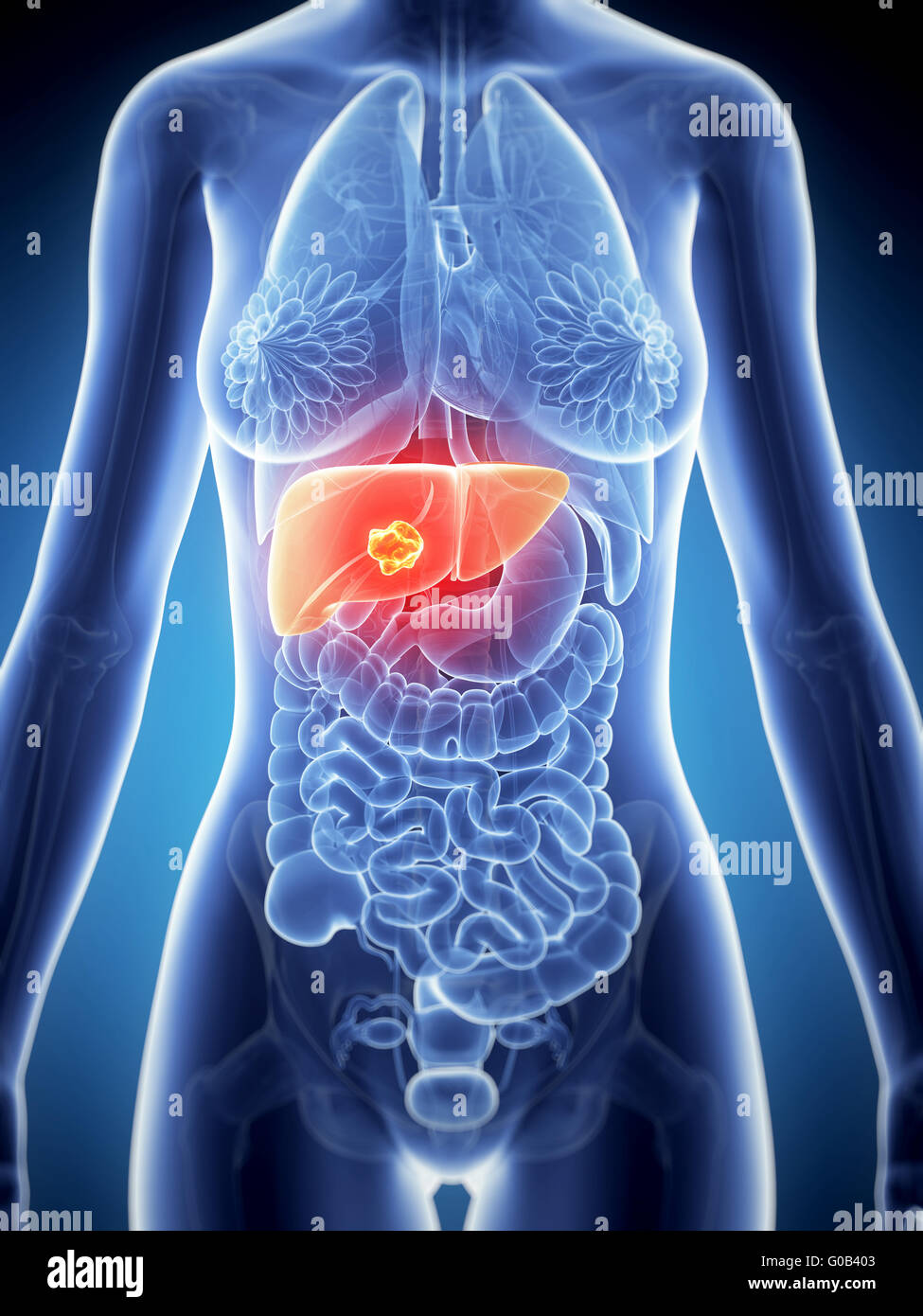3d rendered illustration of the female anatomy - liver cancer Stock ...