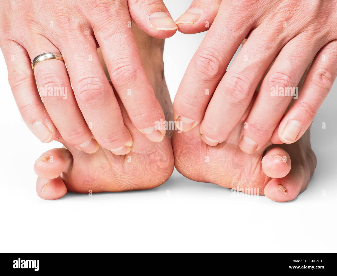 Hands pulling toes on barefoot feet Stock Photo - Alamy