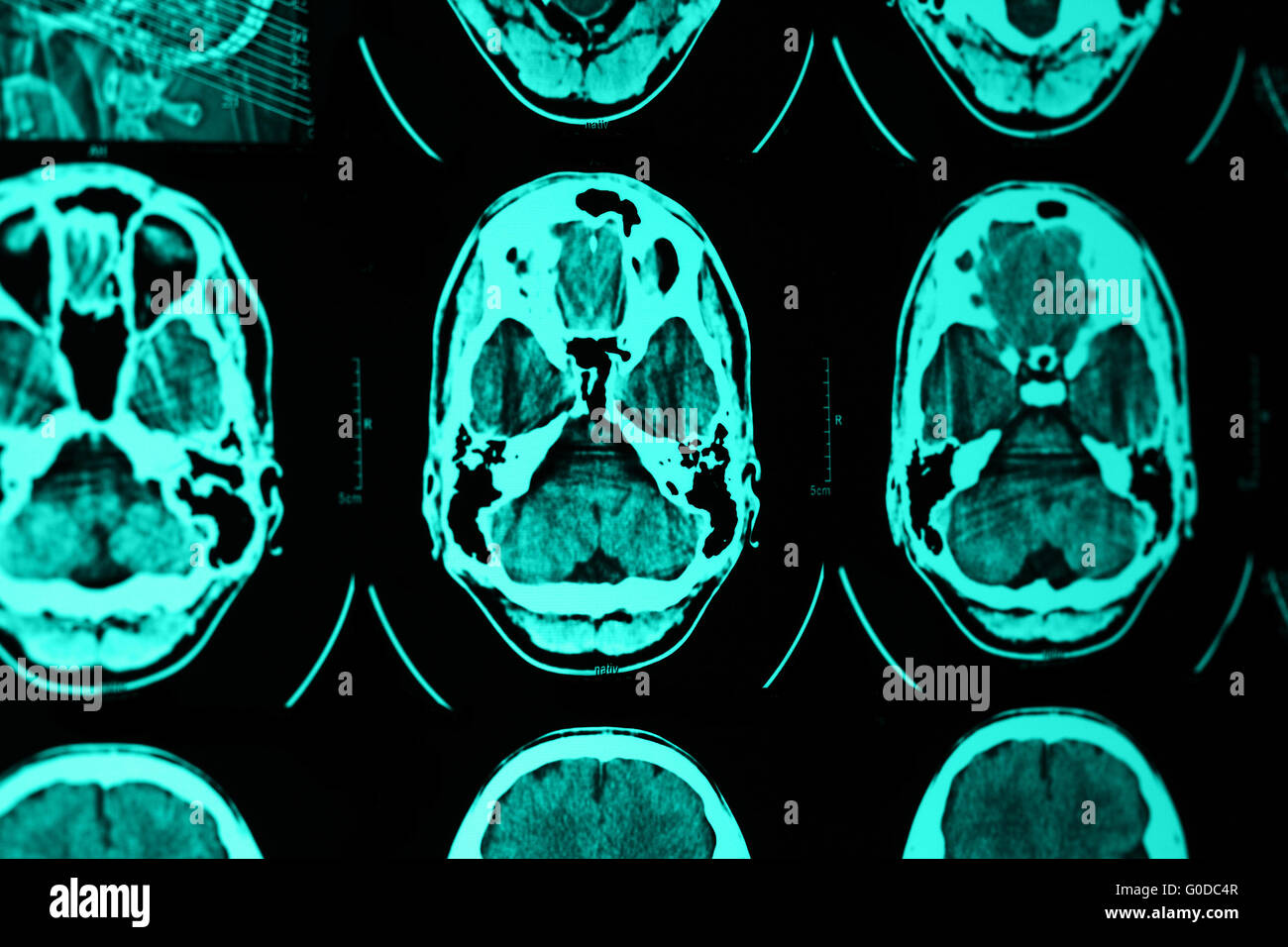Photo of the CT and MRI of the skull Stock Photo - Alamy