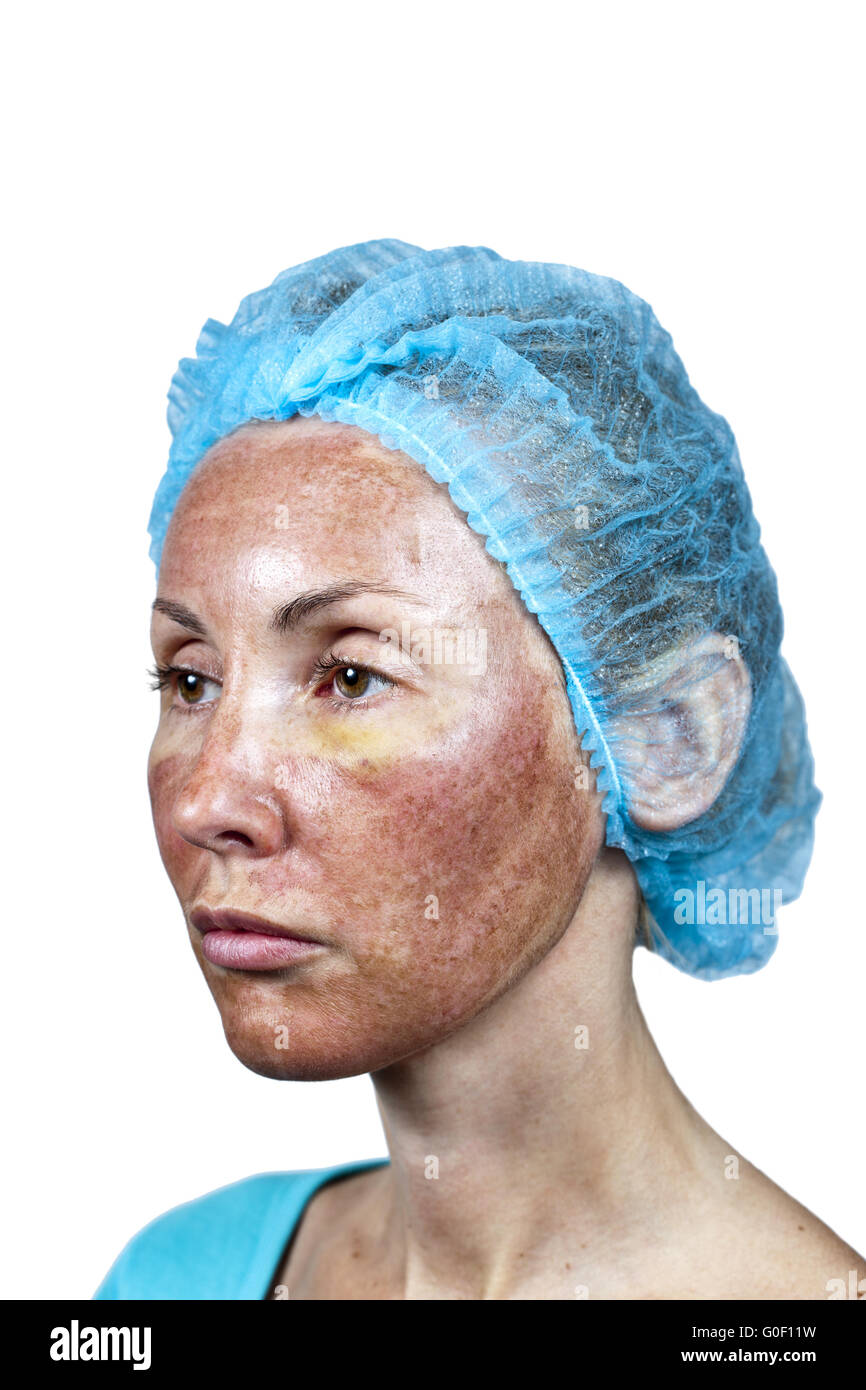 Deep burn skin hi-res stock photography and images - Alamy