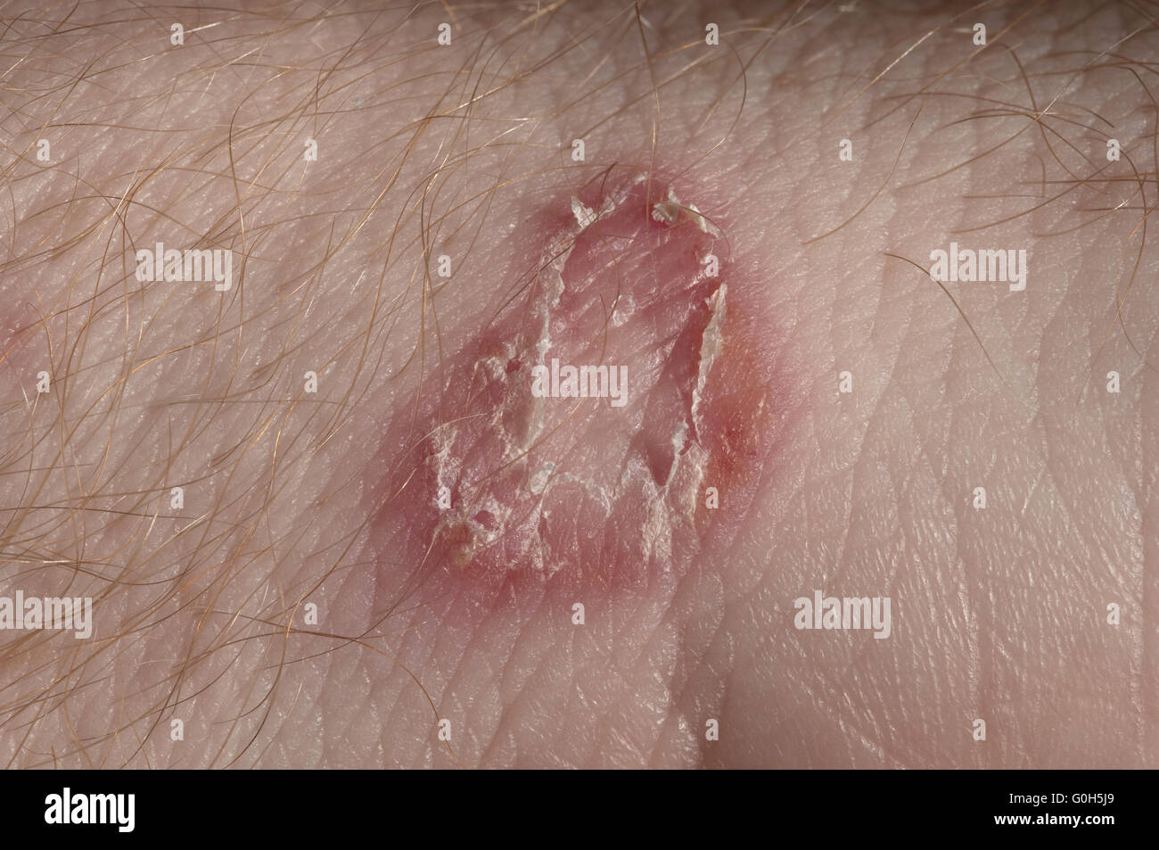 Fungal infection skin arm hi-res stock photography and images - Alamy
