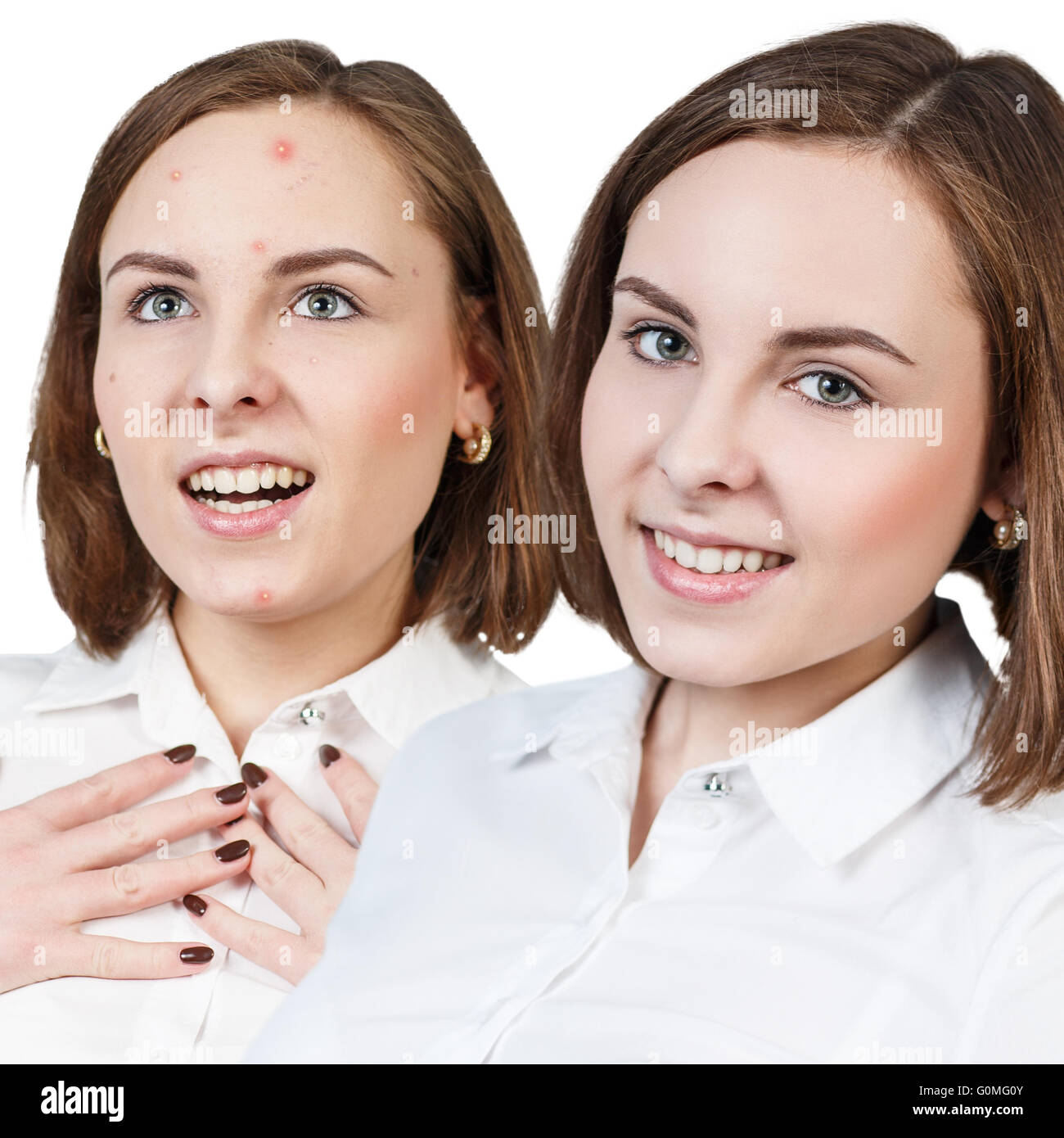 Woman with problem skin on her face Stock Photo - Alamy