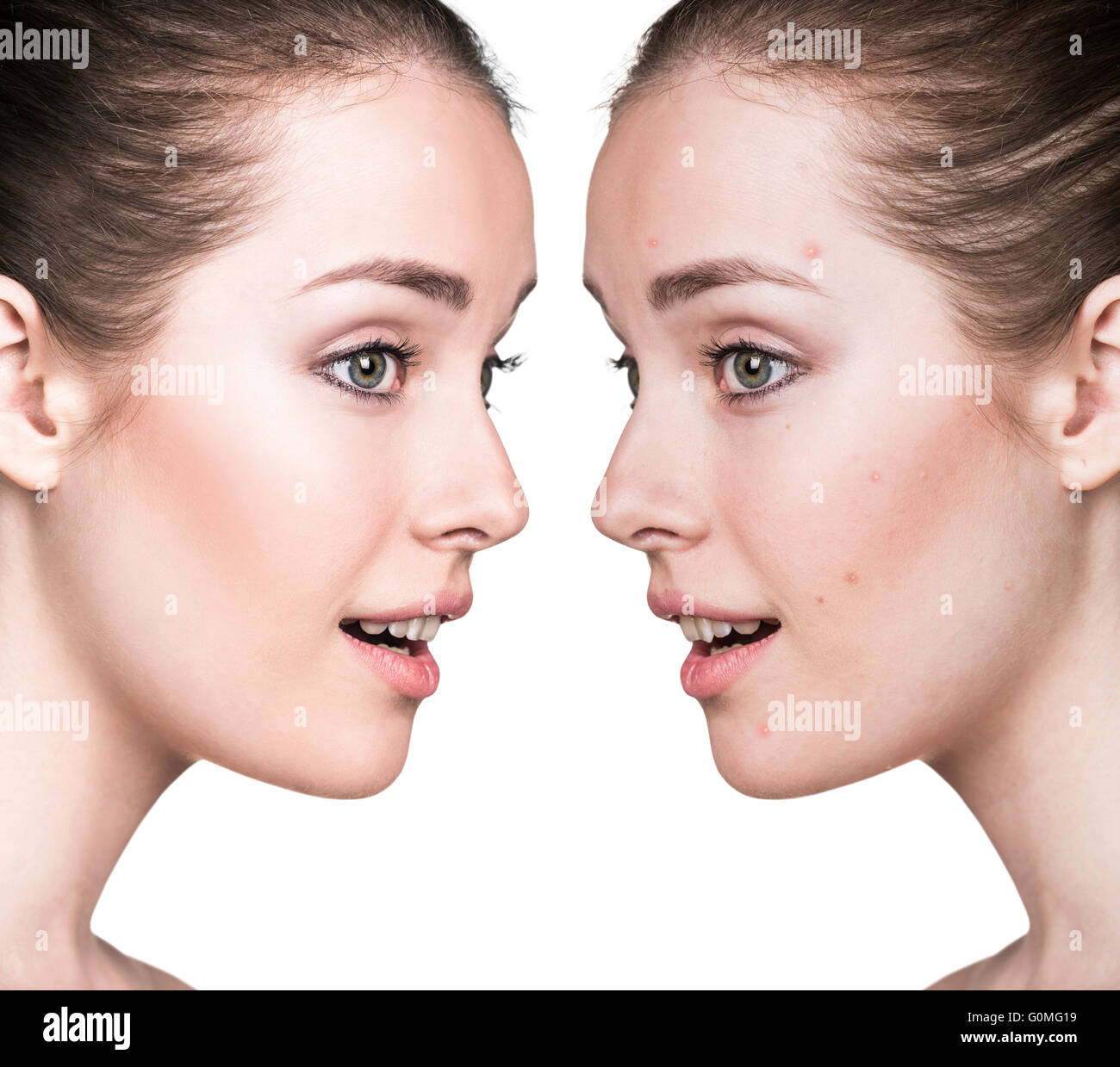 Woman with problem skin on her face Stock Photo - Alamy