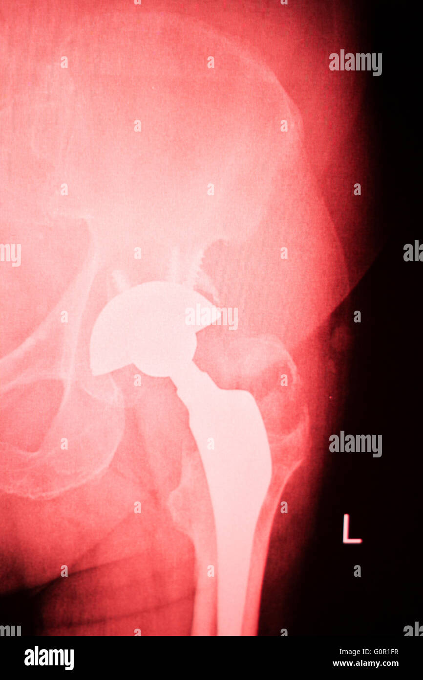 Hip joint implant xray scan test results for adult patient showing ...