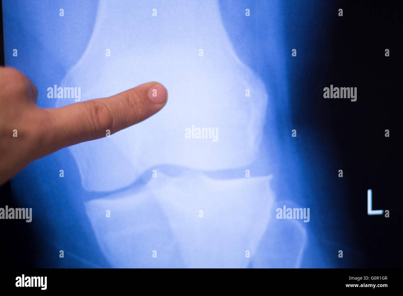 Knee and meniscus injury medical x-ray test scan result for adult ...
