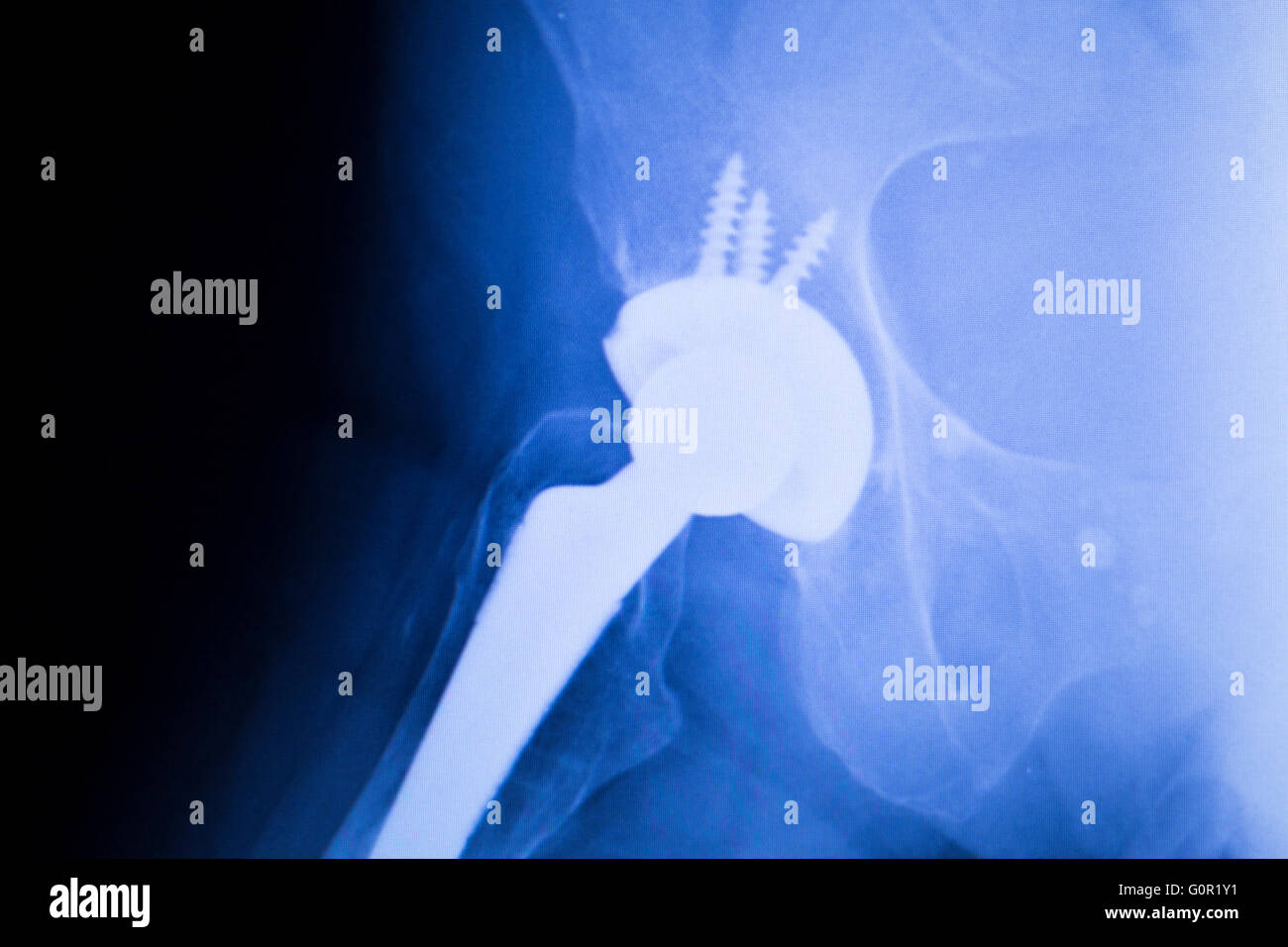 Hip joint implant xray scan test results for adult patient showing ...