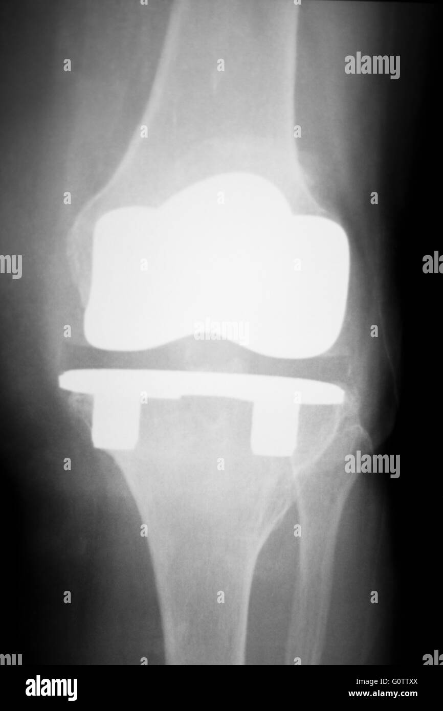Knee and meniscus injury medical x-ray test scan result for adult ...