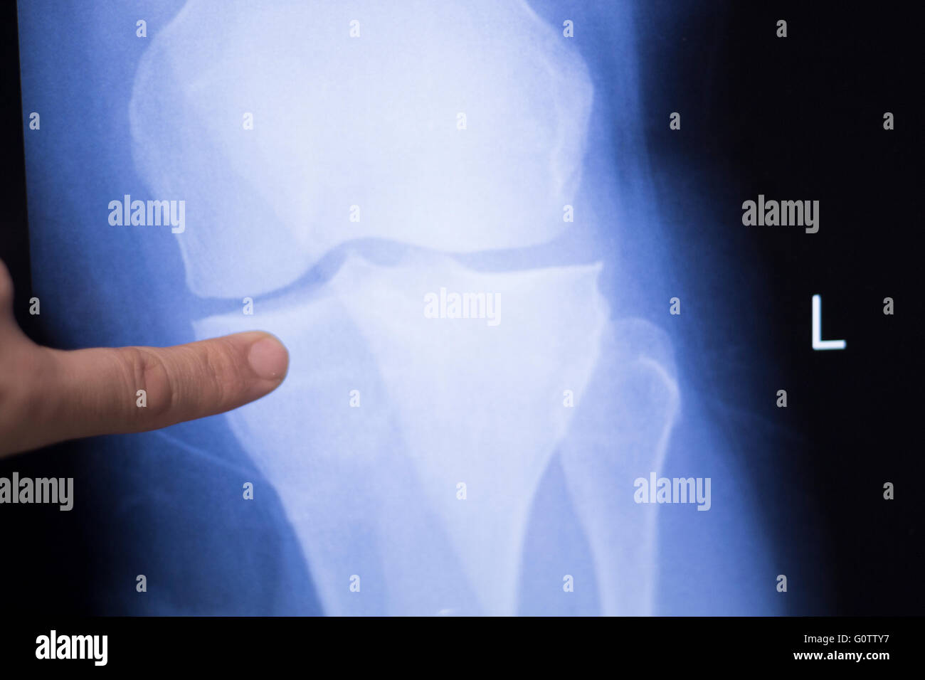 Knee and meniscus injury medical x-ray test scan result for adult ...