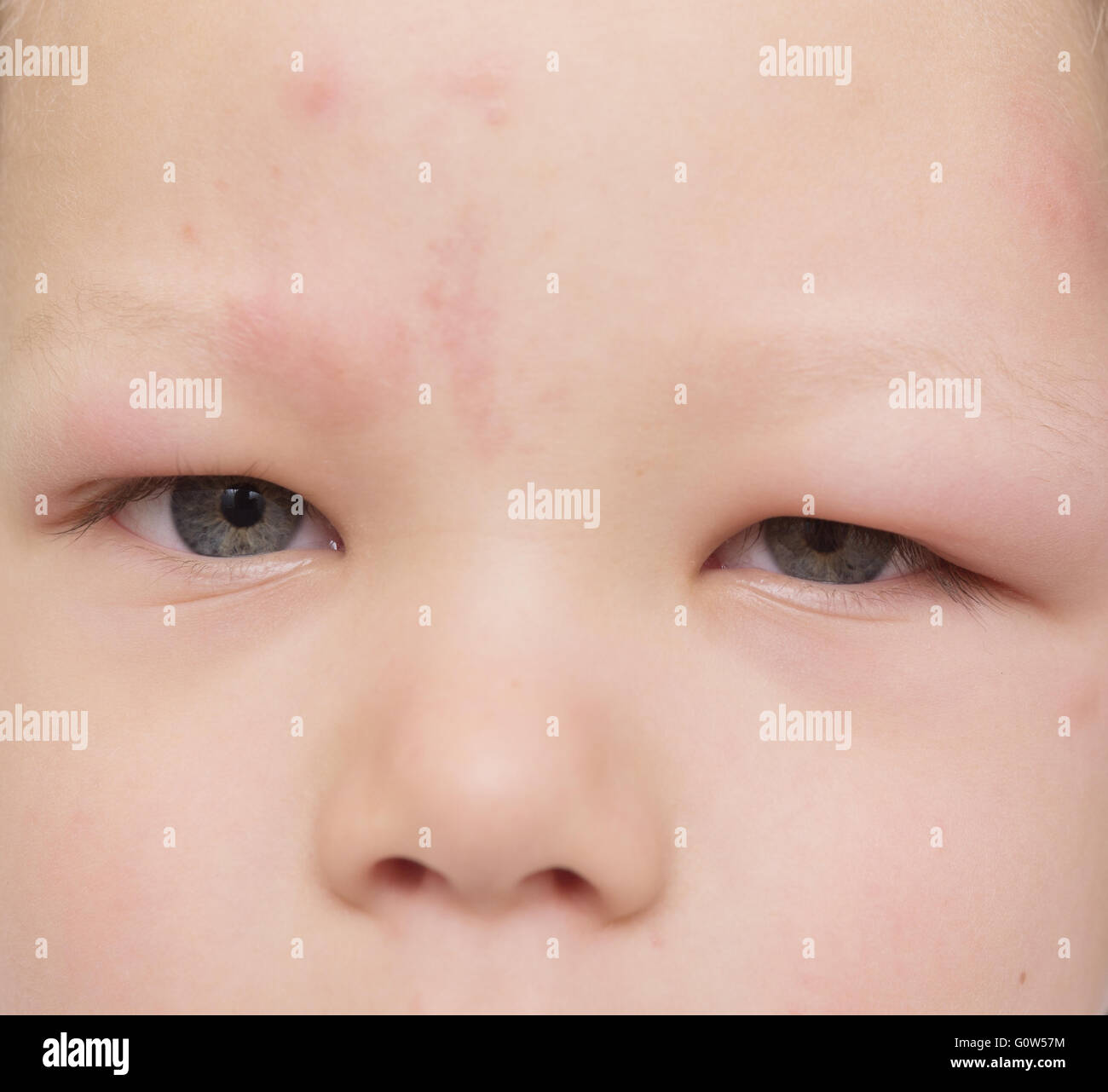 Bug Bite Swelling On Face