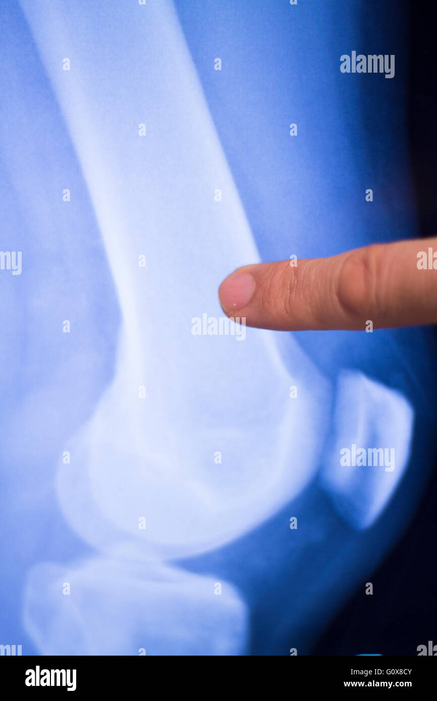Knee and meniscus injury medical x-ray test scan result for adult ...