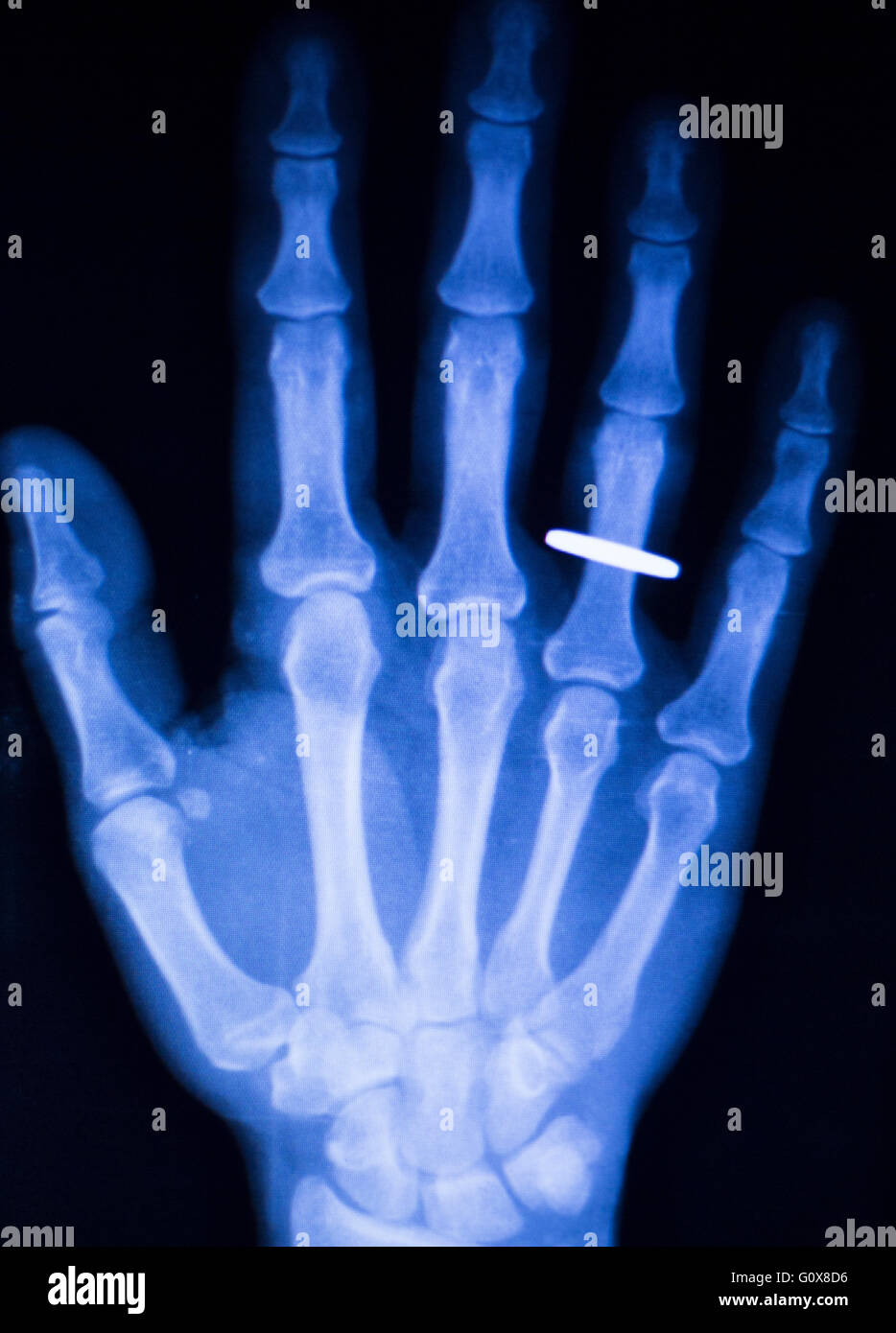 Hand and finger injury medical x-ray test scan result for adult patient ...
