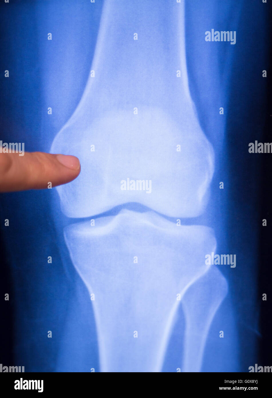 Knee and meniscus injury medical x-ray test scan result for adult ...