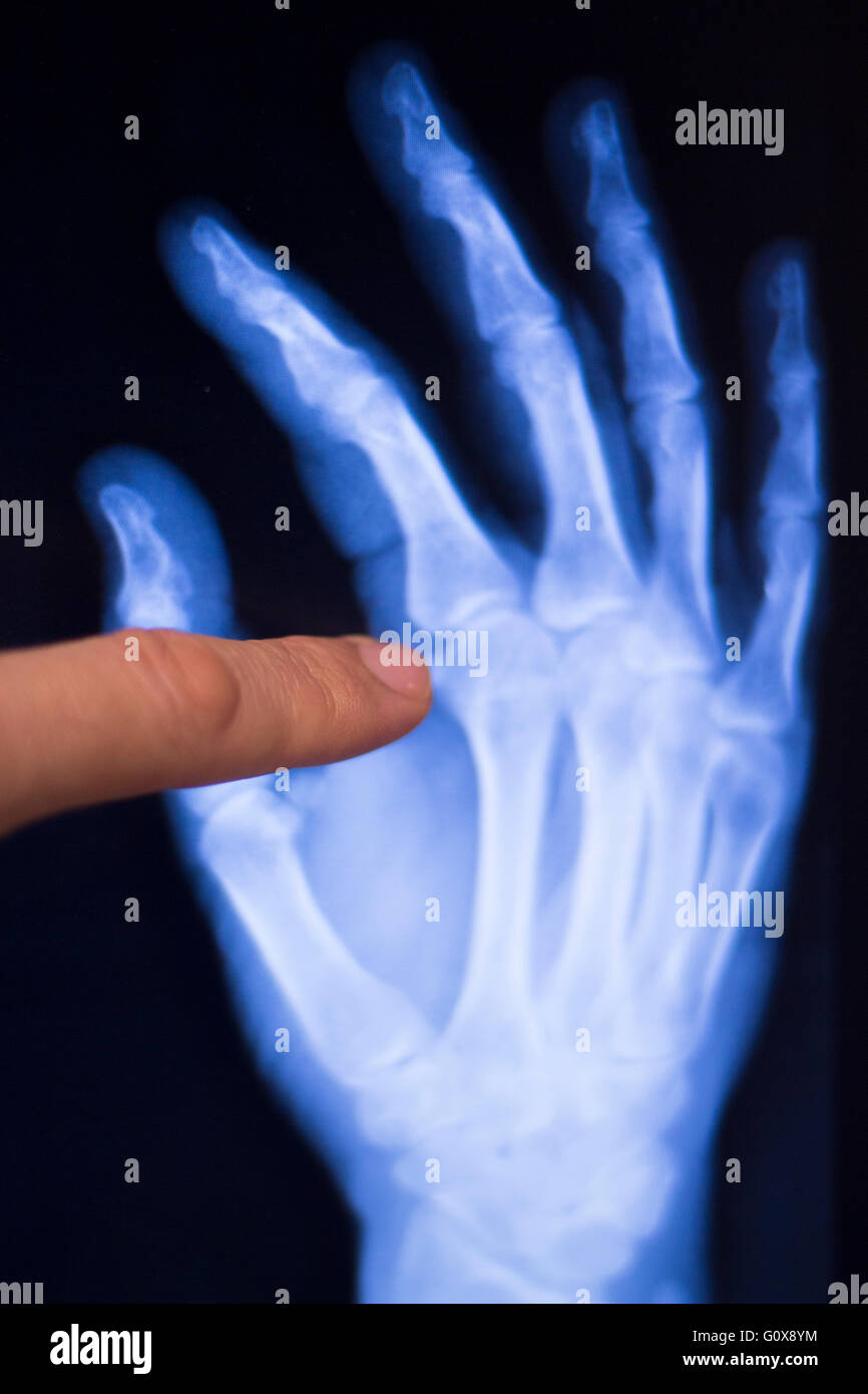 Hand and finger injury medical x-ray test scan result for adult patient ...