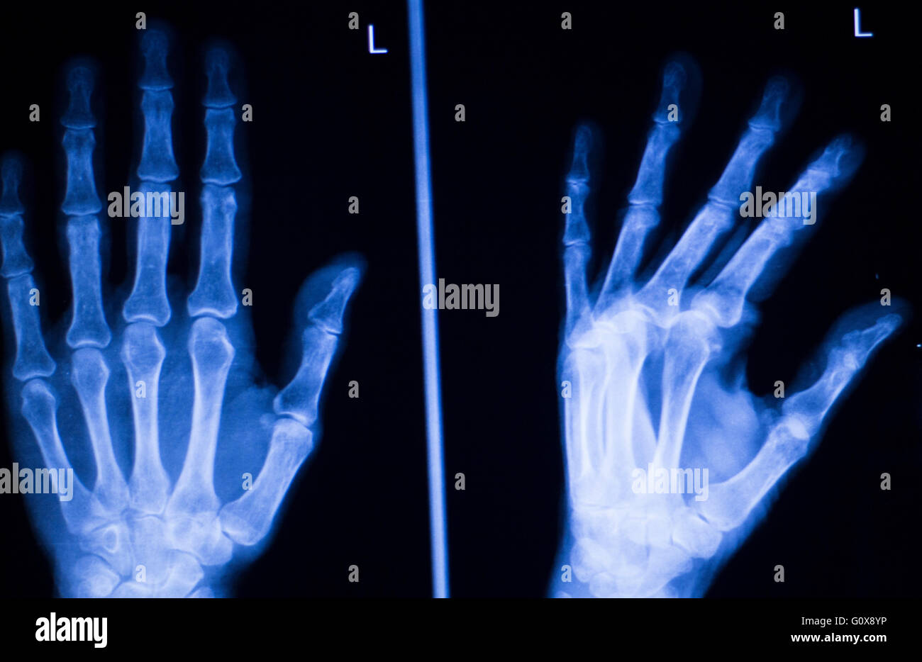 Hand and finger injury medical x-ray test scan result for adult patient ...