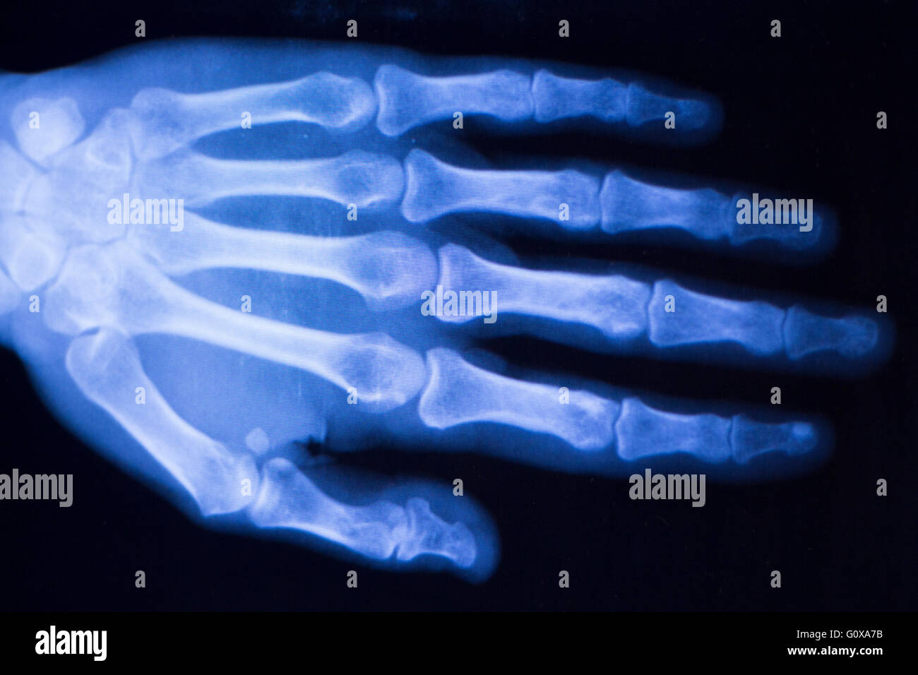 Hand and finger injury medical x-ray test scan result for adult patient ...