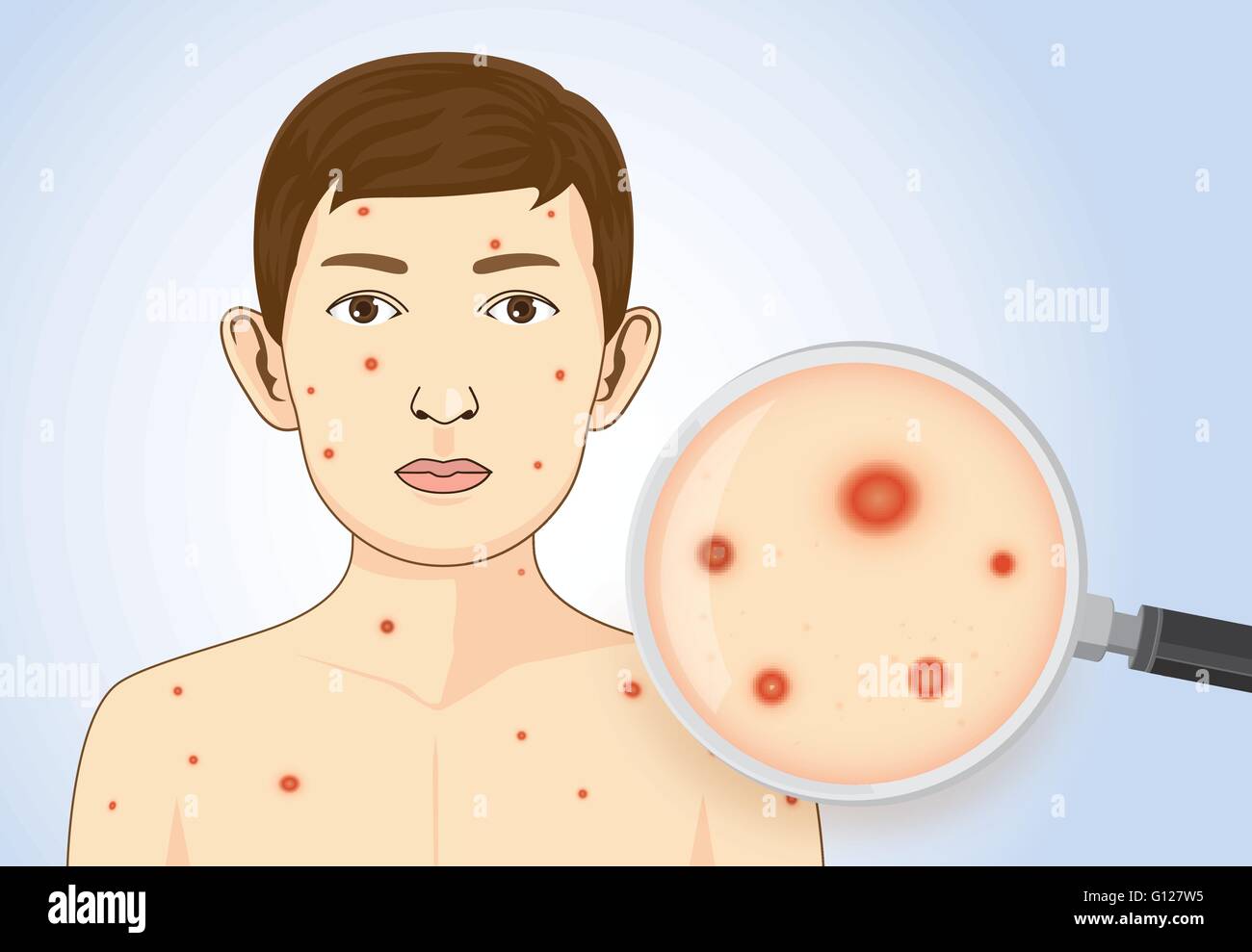 Skin illustration diagram disease cartoon hi-res stock photography and ...