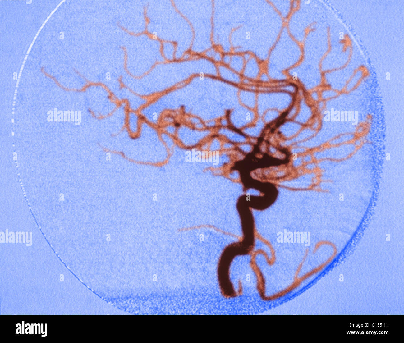 Color enhanced angiogram of cerebral blood vessels Stock Photo - Alamy